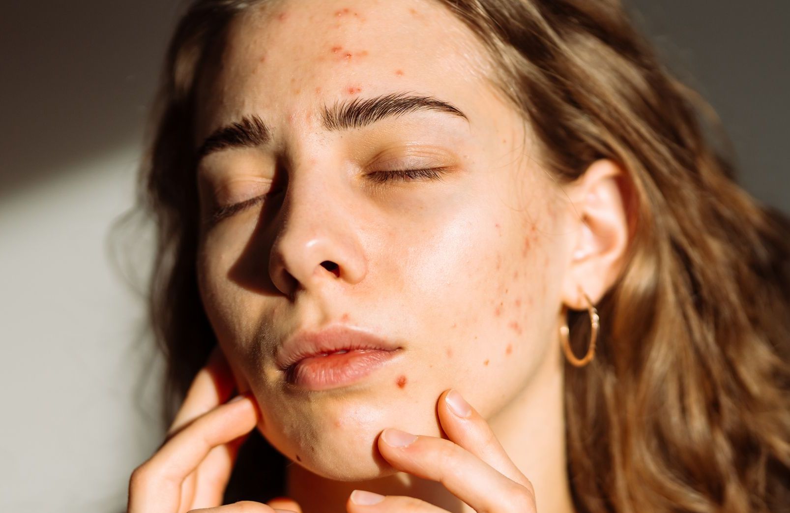 Acné, psoriasis, eczéma… quand les problèmes de peau fragilisent notre ...